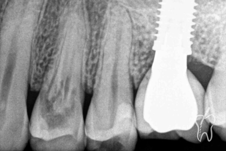 Caso clínico | Manejo de una reabsorción cervical invasiva - Endogal