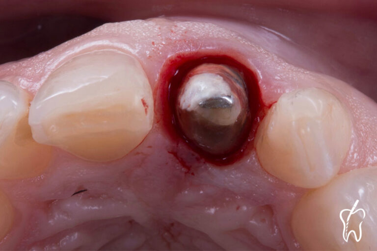 Uso de la técnica BOPT para la restauración de dientes endodonciados ...